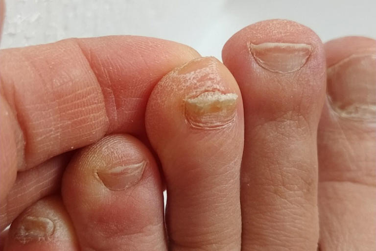 Should you be concerned about toenail fungus?