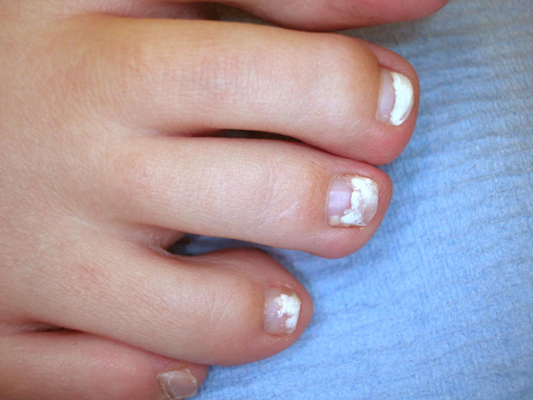 Should you be concerned about toenail fungus?