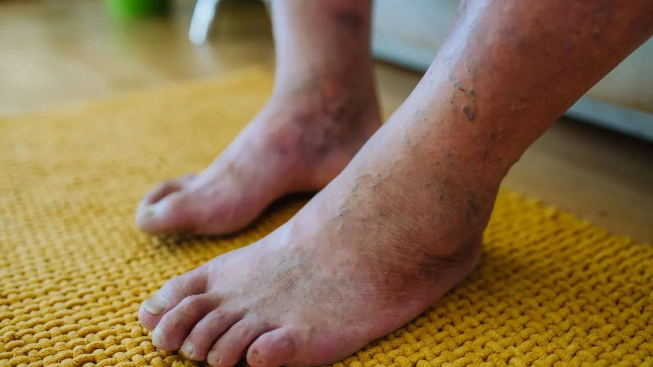 These 3 persistent changes in your feet may be a sign of high cholesterol