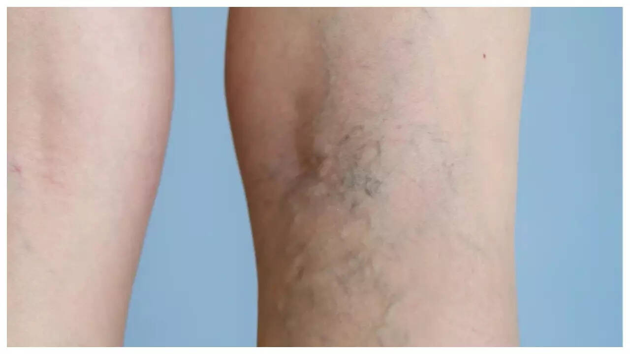 Leading vascular surgeon reveals 5 warning signs of deep vein issues ...