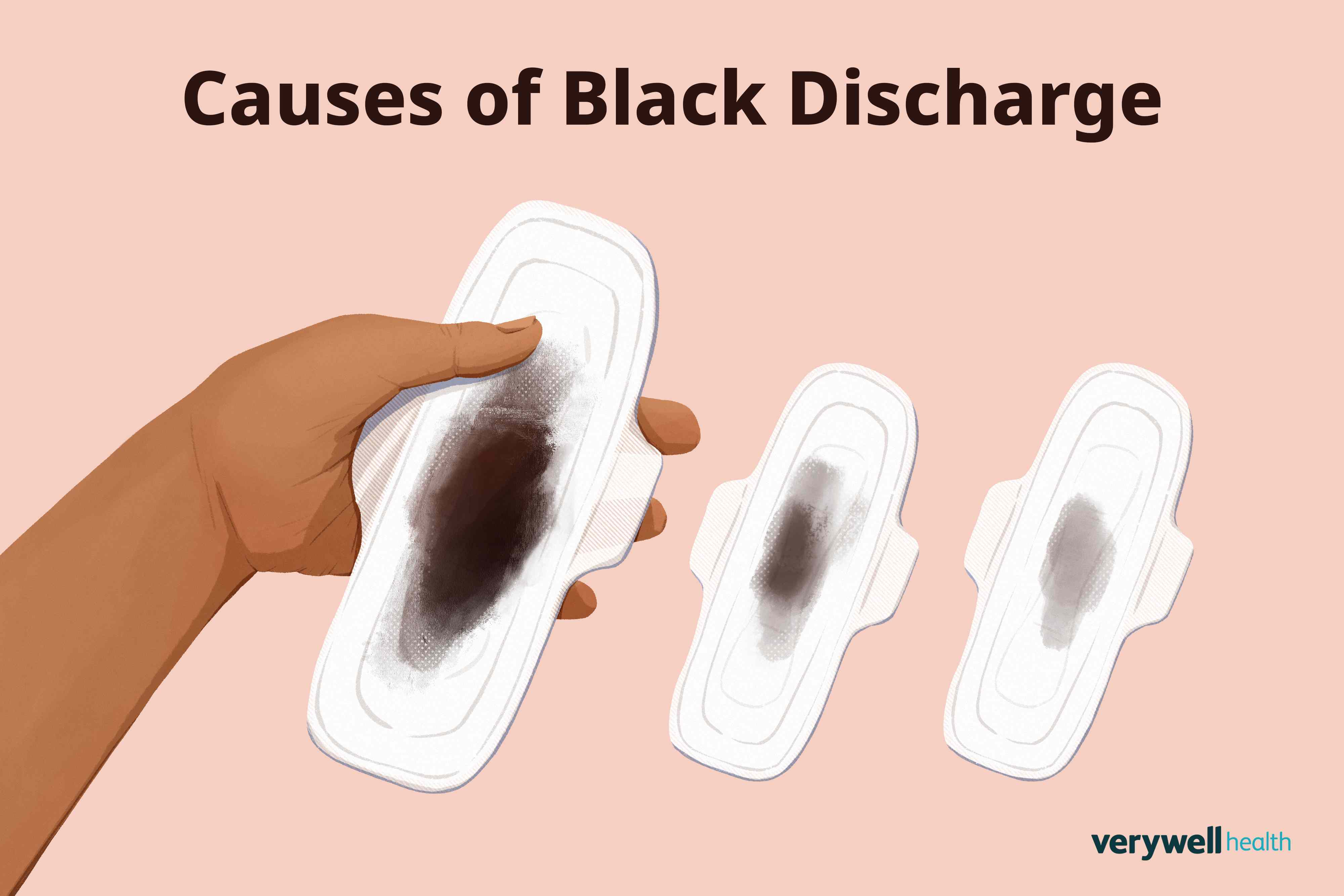 Is black discharge normal? Causes & treatment options