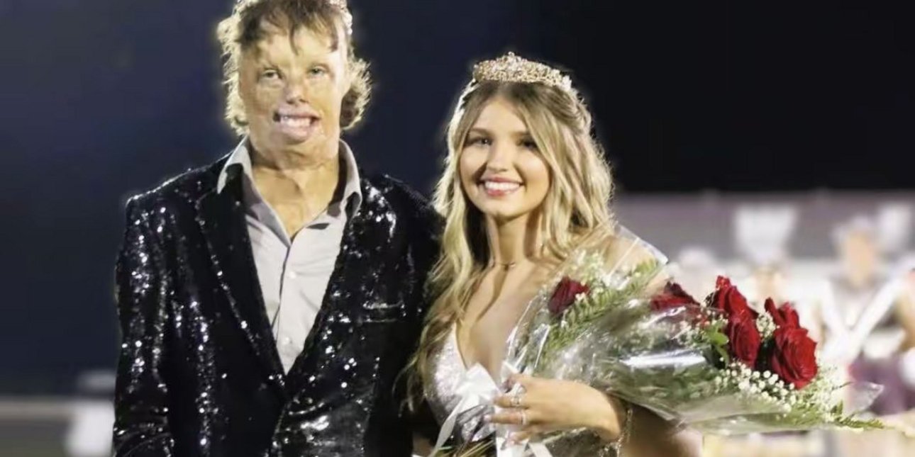 Μια ιστορία επιμονής: Σε ηλικία 18 μηνών, μια φωτιά τού άλλαξε τη ζωή ...