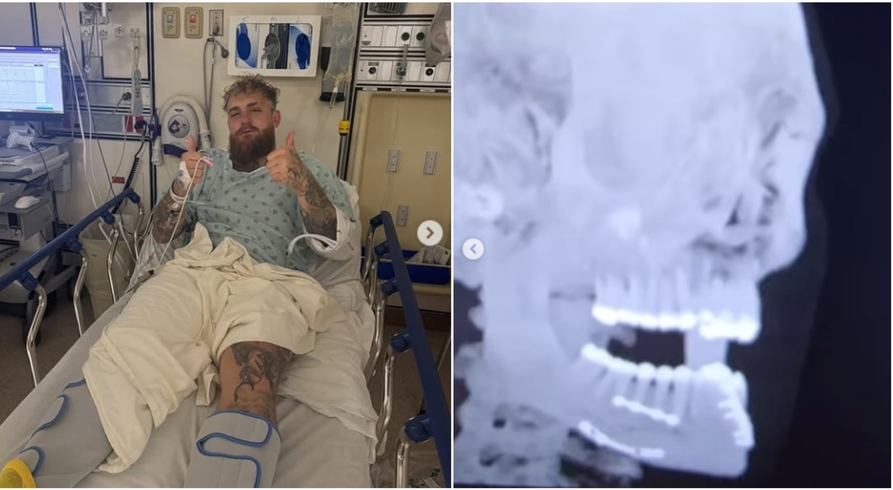 Jake Paul mostra la radiografia con la mascella rotta dal pugno di ...