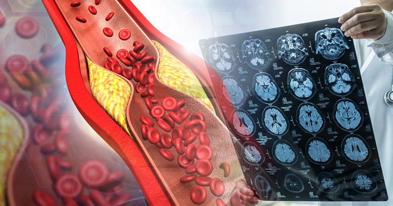 3 things people with high blood pressure and high cholesterol should ...