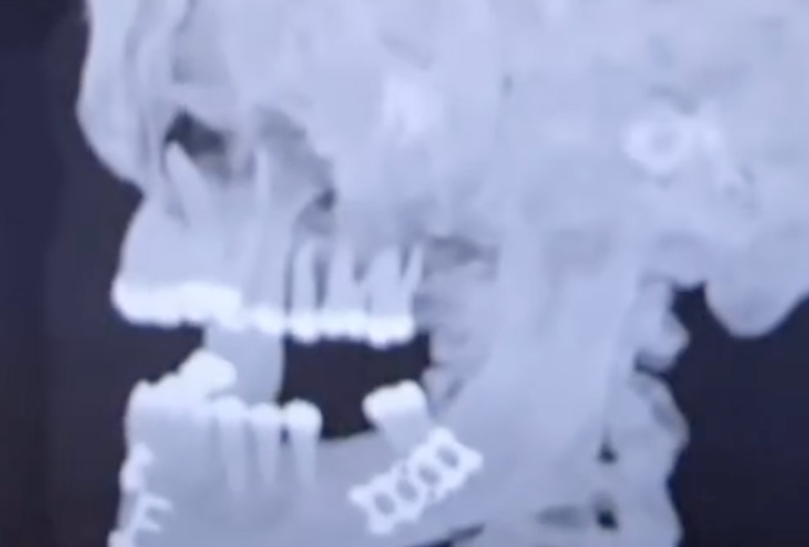 Jake Paul posts X-ray of missing teeth, titanium plates from jaw ...