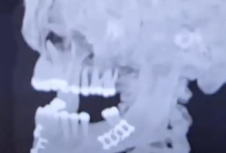 Jake Paul posts X-ray of missing teeth, titanium plates from jaw ...