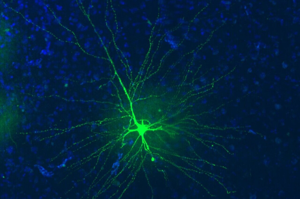 How brain tumor cells influence neurons and vice versa