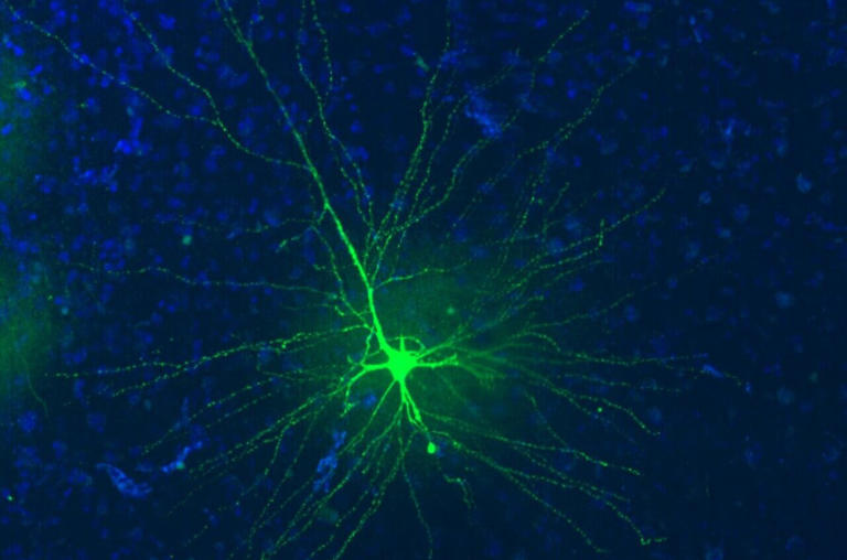How brain tumor cells influence neurons and vice versa