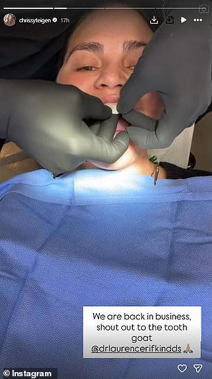 Chrissy Teigen reveals chipped tooth after candy cane game mishap with ...