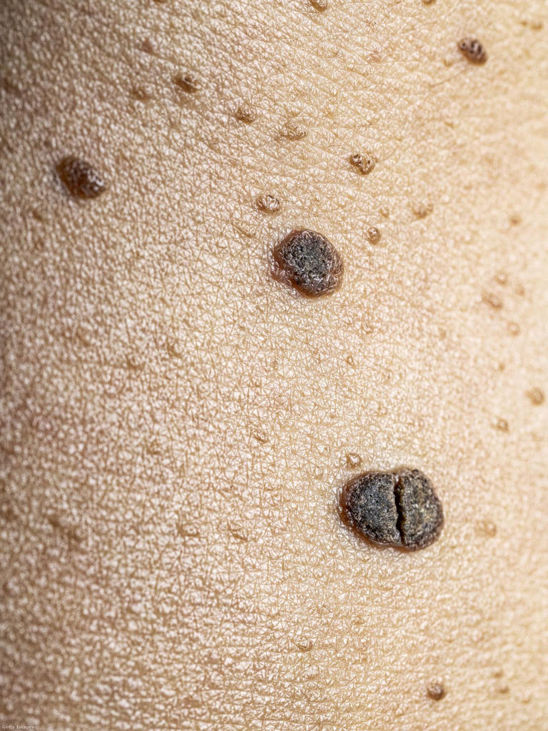 30 perc alatt elpusztította a bőrrák 92%-át: ez a felfedezés áttörést ...