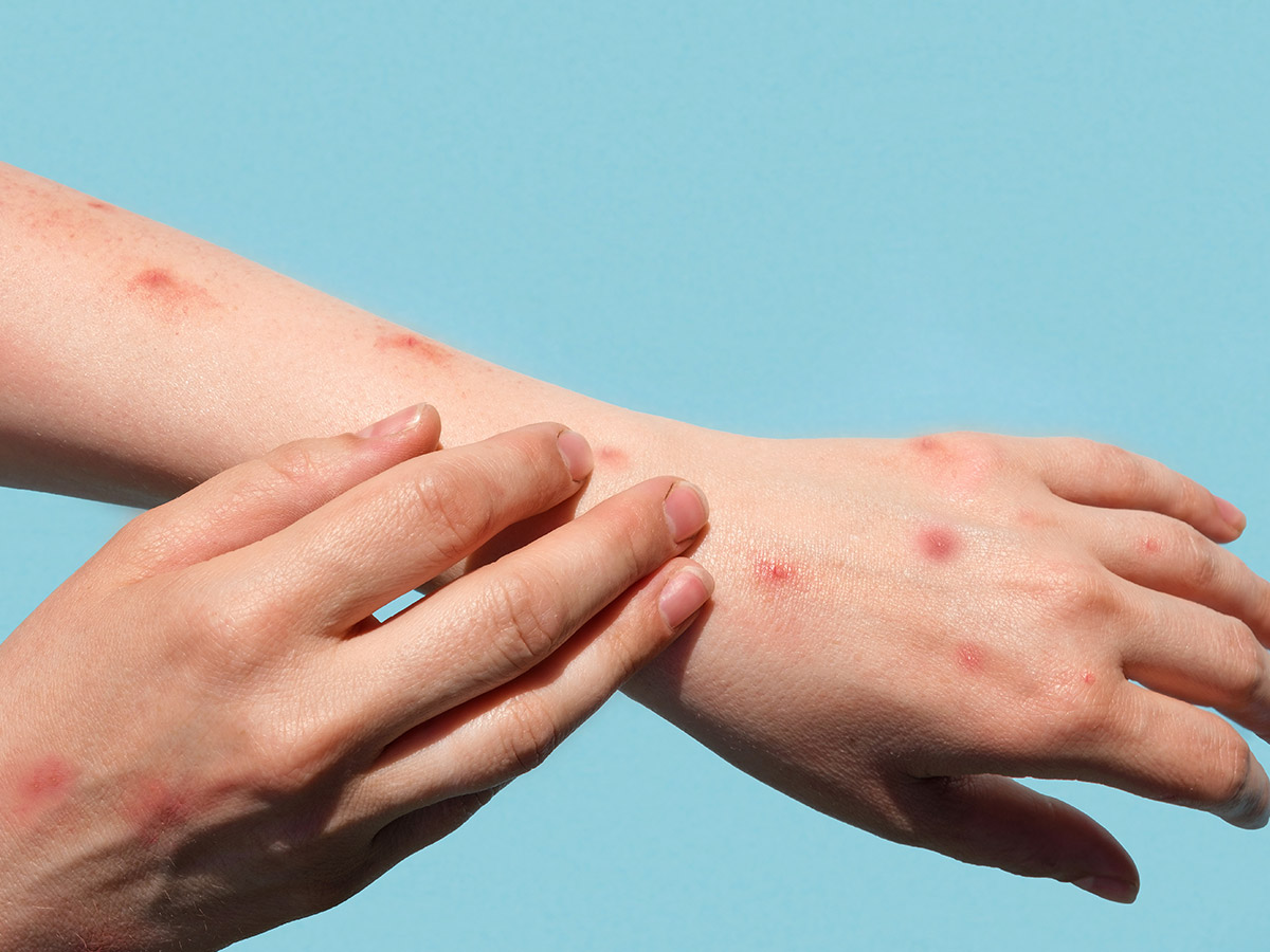 What everyone needs to know about chickenpox and shingles—told in 10 slides