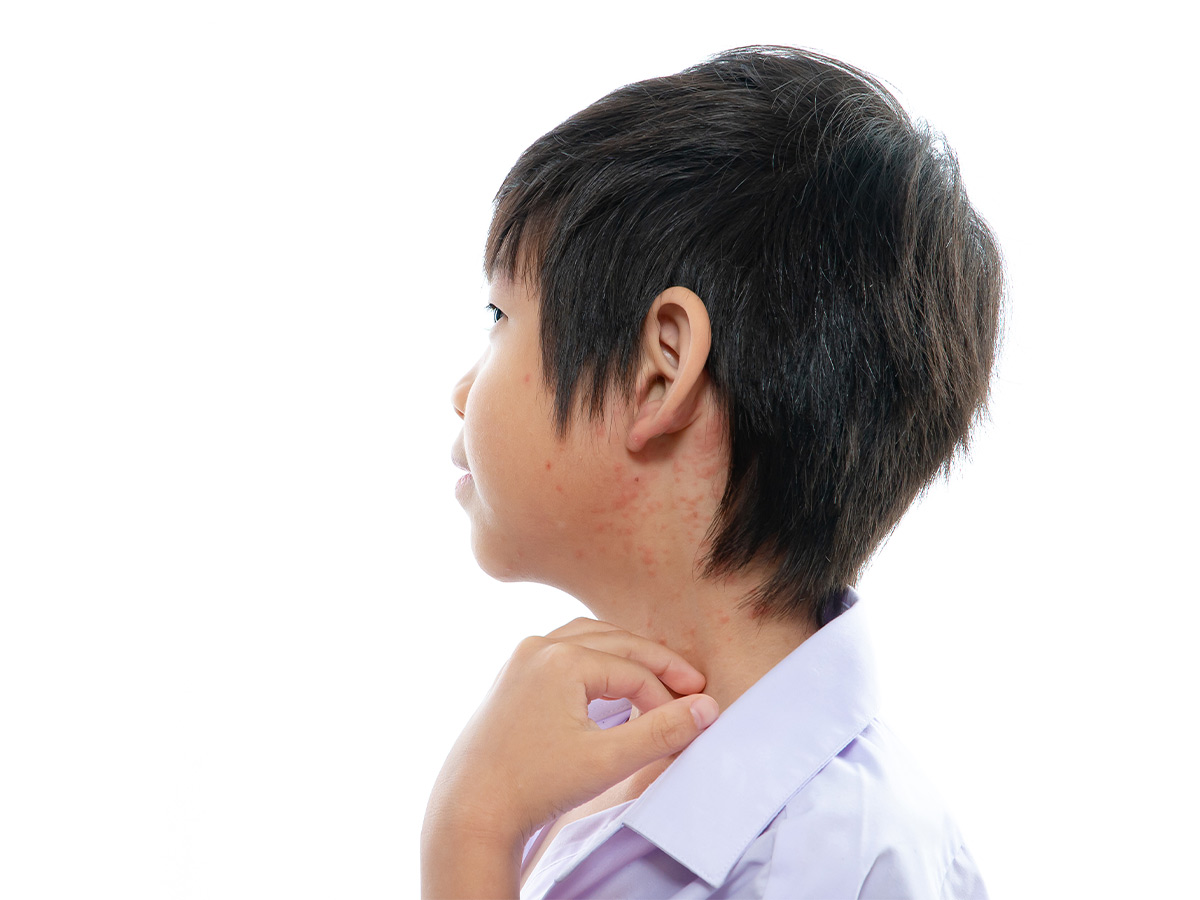 What everyone needs to know about chickenpox and shingles—told in 10 slides