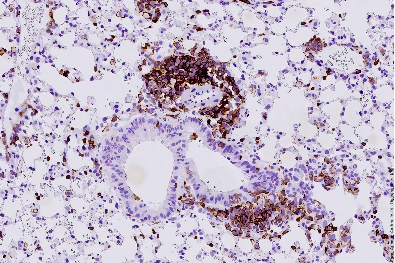 Inflammation fuels one of the most aggressive forms of lung cancer