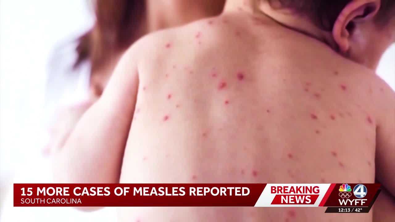 3 children in WNC test positive for measles after visit to Spartanburg ...