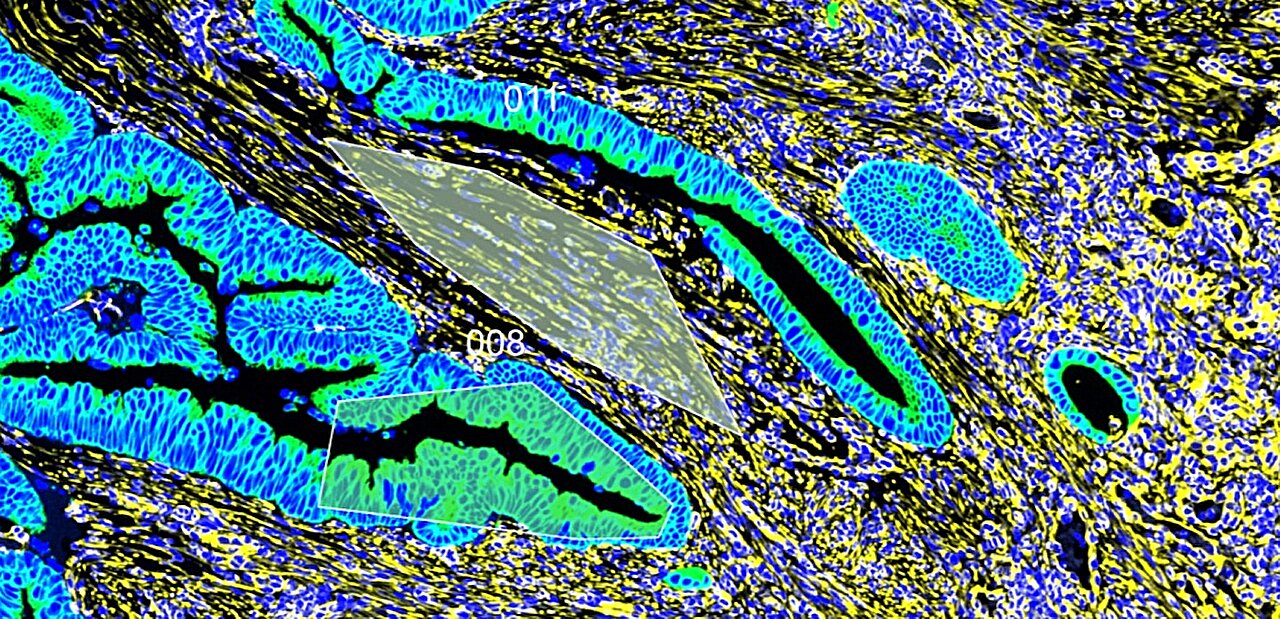 Stiffer colon could signal risk of early-onset colorectal cancer