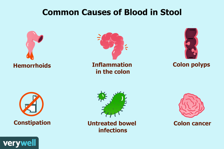 Bright red blood in stool: Should I worry?