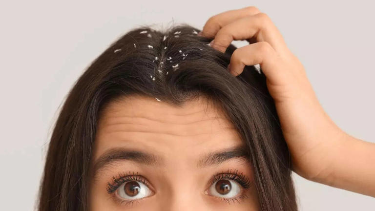 Dandruff is more than just poor hygiene; know what your scalp is ...