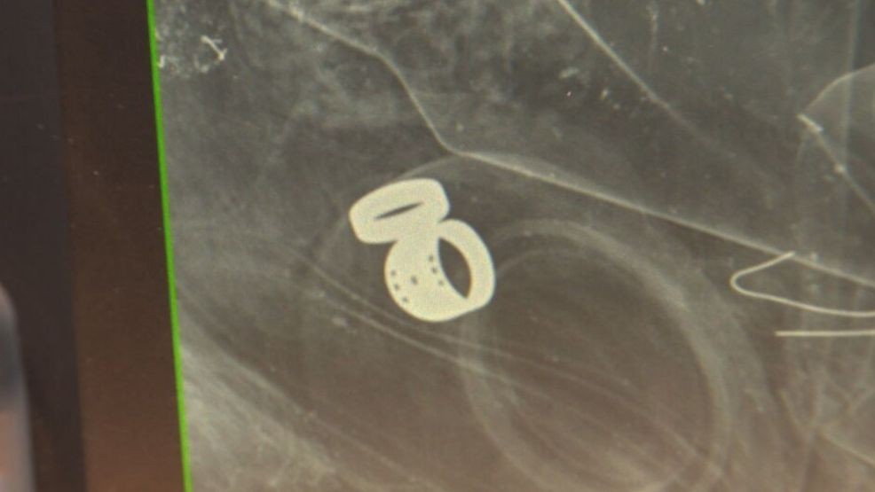 Hospital staff use X-ray, teamwork to recover patient’s lost heirloom rings