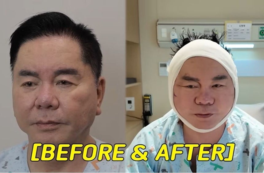 Shim Hyung-rae undergoes facelift for YouTube channel debut