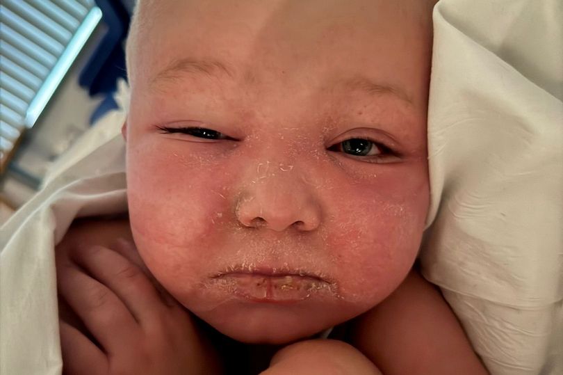 Toddler's suspicious rash over Christmas turns out to be leukemia