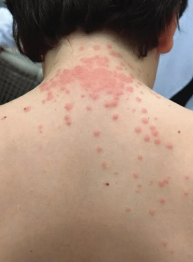 Virginia family covered in 'itchy welts, lesions and rashes' from bed ...