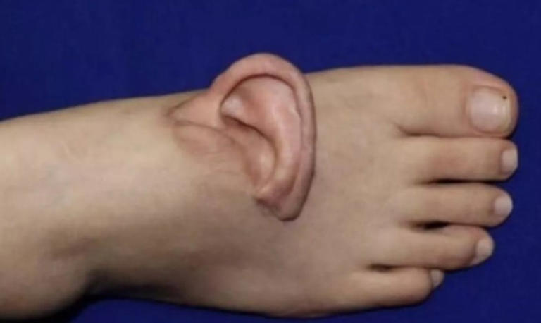 Chinese woman’s ear reattached via foot transplant