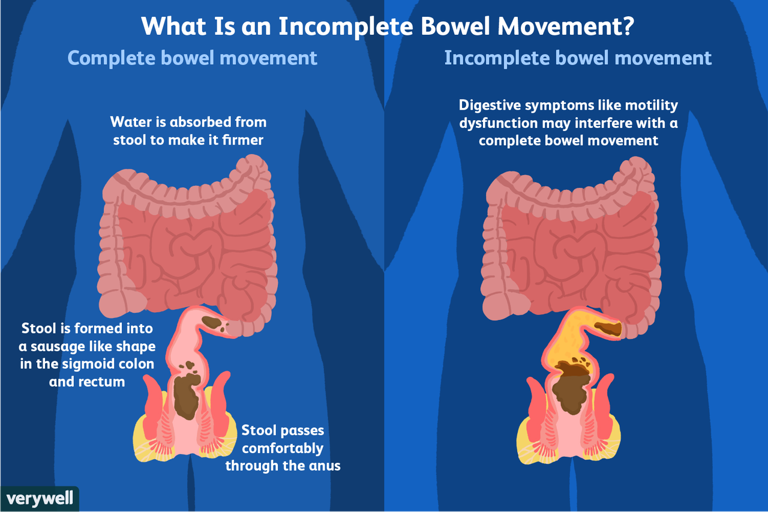 Remedies for incomplete bowel movements