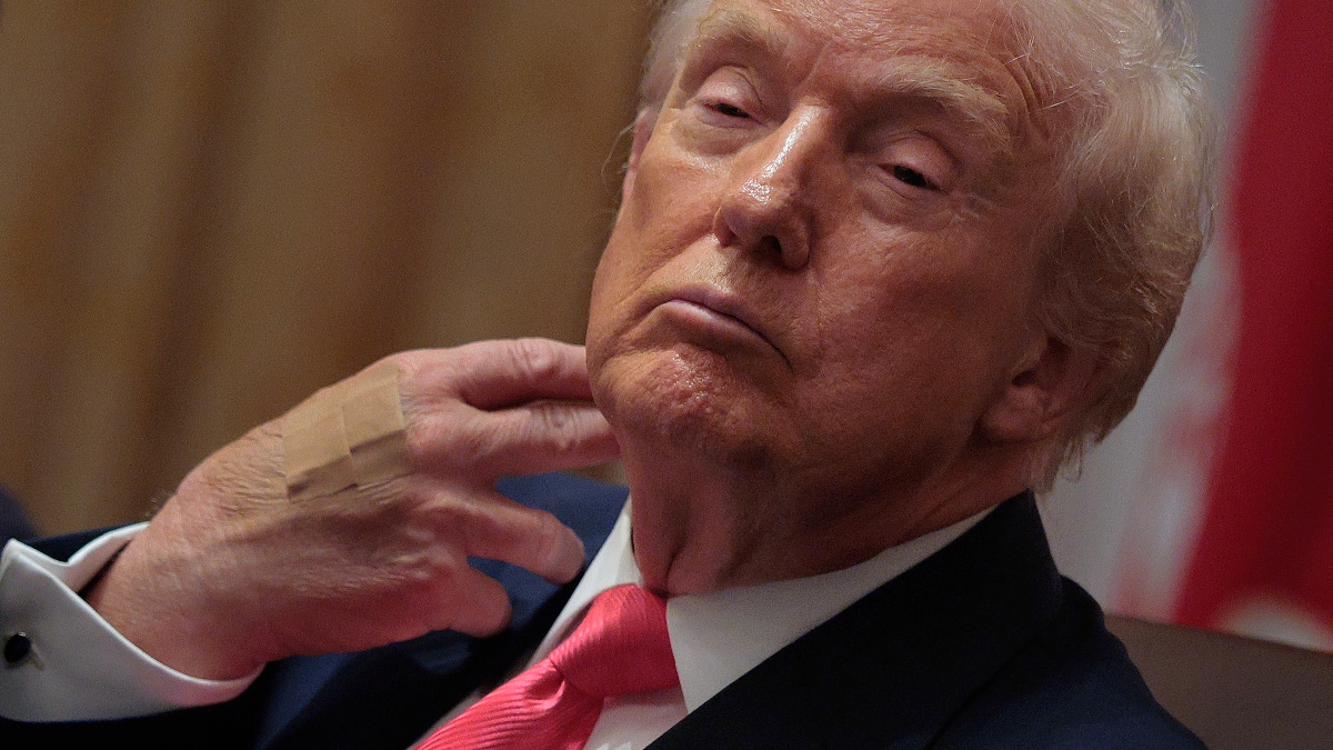 Trump’s bandaged hand triggers questions; White House clarifies 'He’s ...