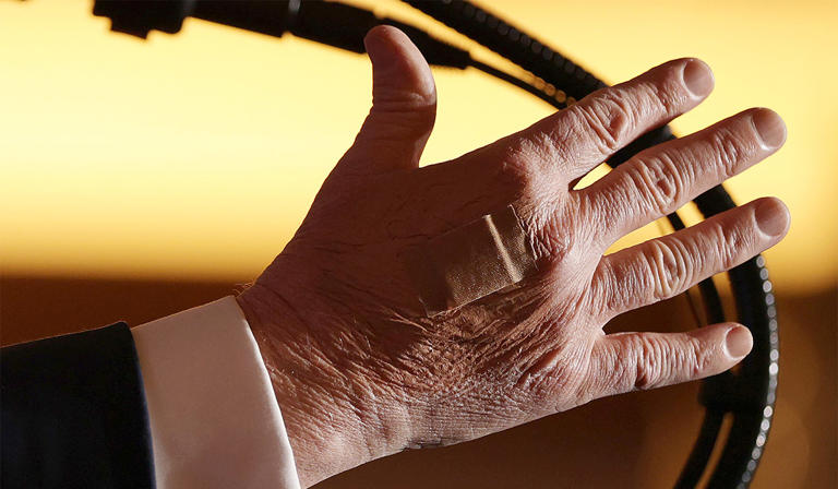 White House explains Donald Trump’s bandaged hand amid health concerns