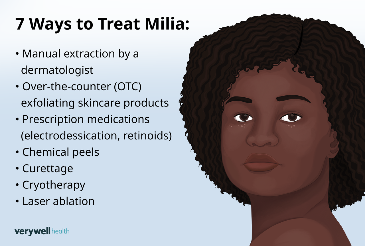 8 ways to get rid of milia