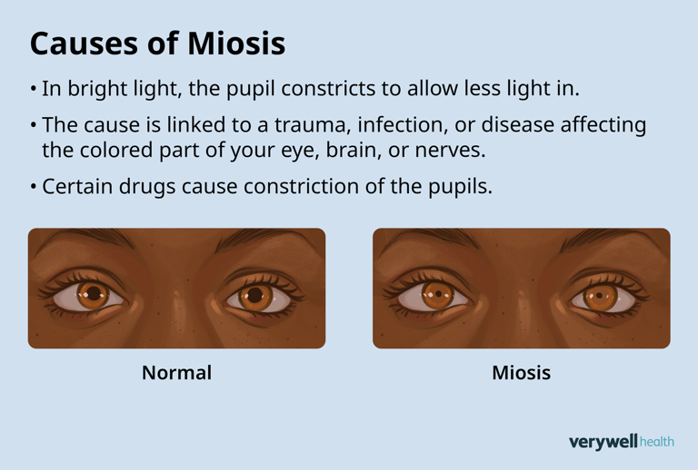 What causes eye miosis (constricted pupils)