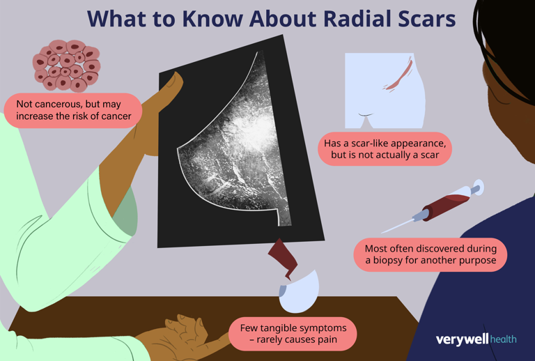 What you need to know about radial scars and breast cancer risk