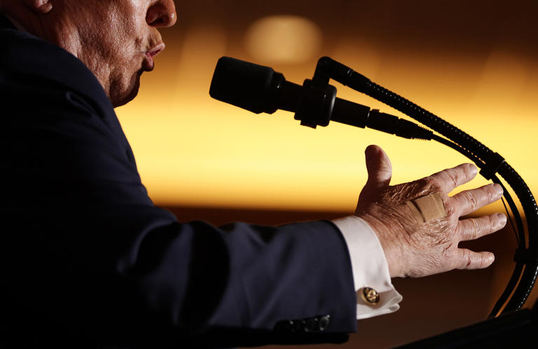 Trump, 79, slathers bruised hand in makeup for his favorite show