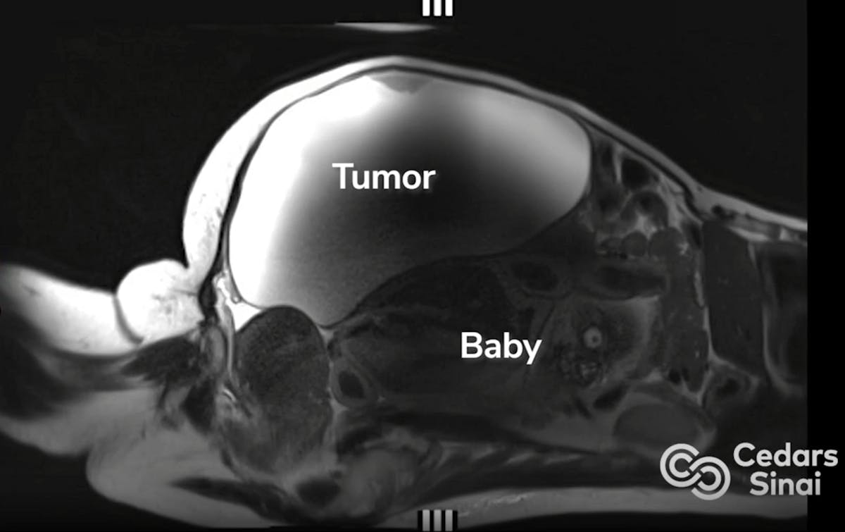 Suze rückt zur Zysten-OP an – und bekommt gesundes Baby