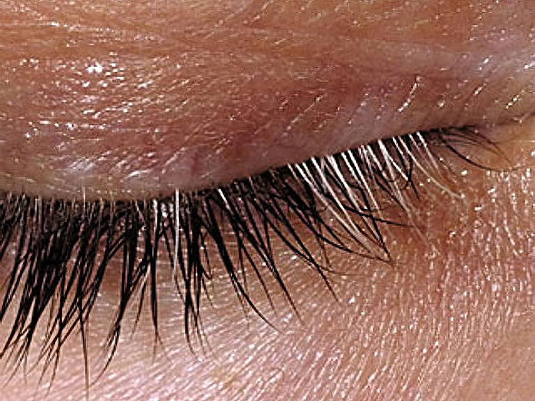 what-you-need-to-know-about-poliosis-circumscripta-causes-and-symptoms