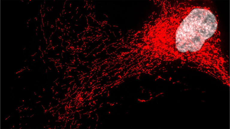 'Zombie' cells spark inflammation in severe fatty liver disease ...