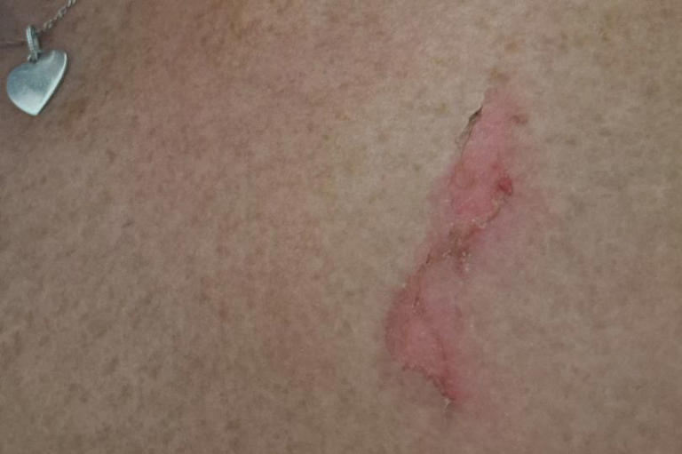 Woman left with painful burns and blisters from £2 Shein bra as she ...