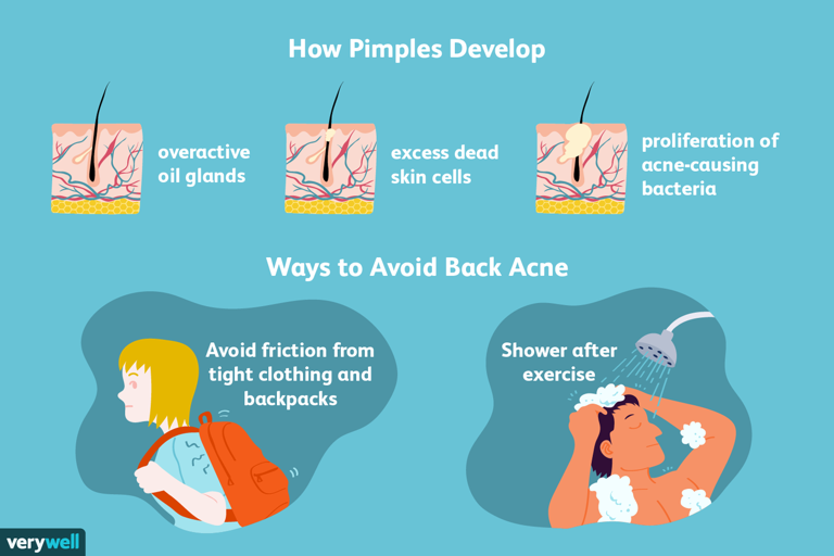 Causes of body acne and how to get rid of it