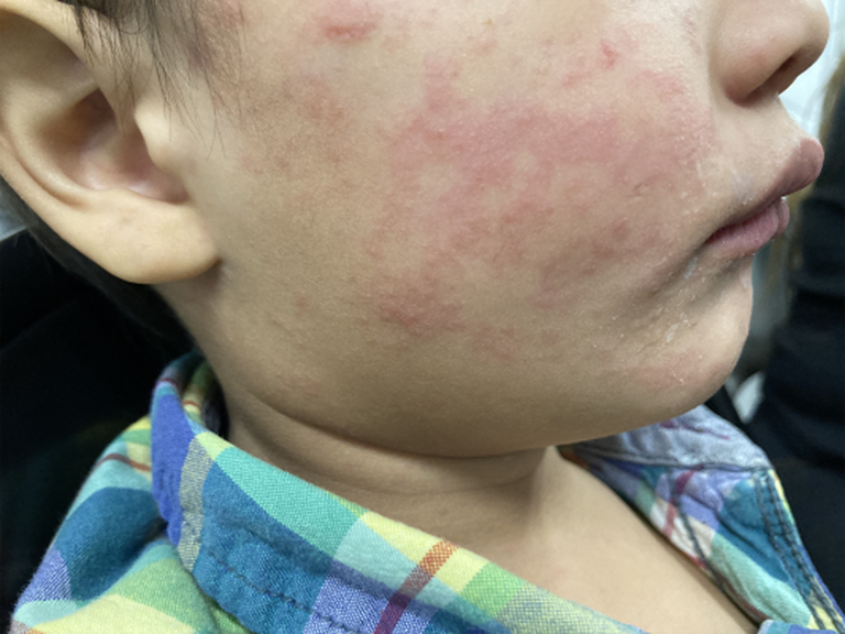 A child developed measles in Polk County, the second NC case in a year