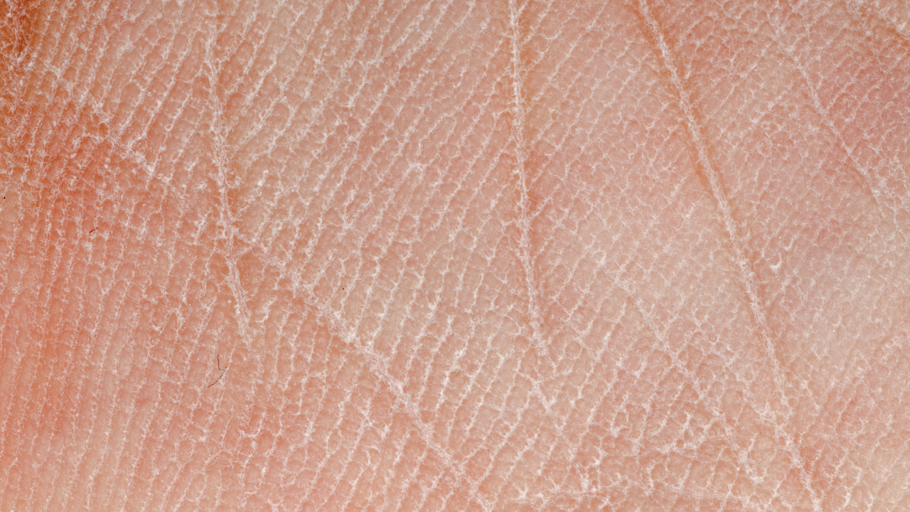 7 skin symptoms that may signal uncontrolled diabetes