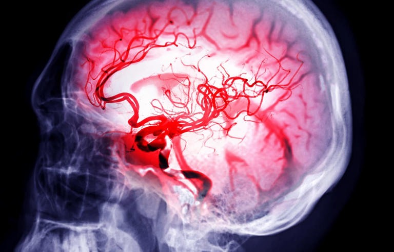 New drug combination boosts life expectancy from grade 3 brain tumors ...