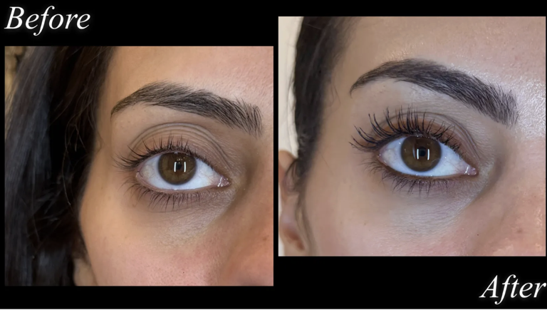 This buzzy neck treatment is the next big thing in plastic surgery