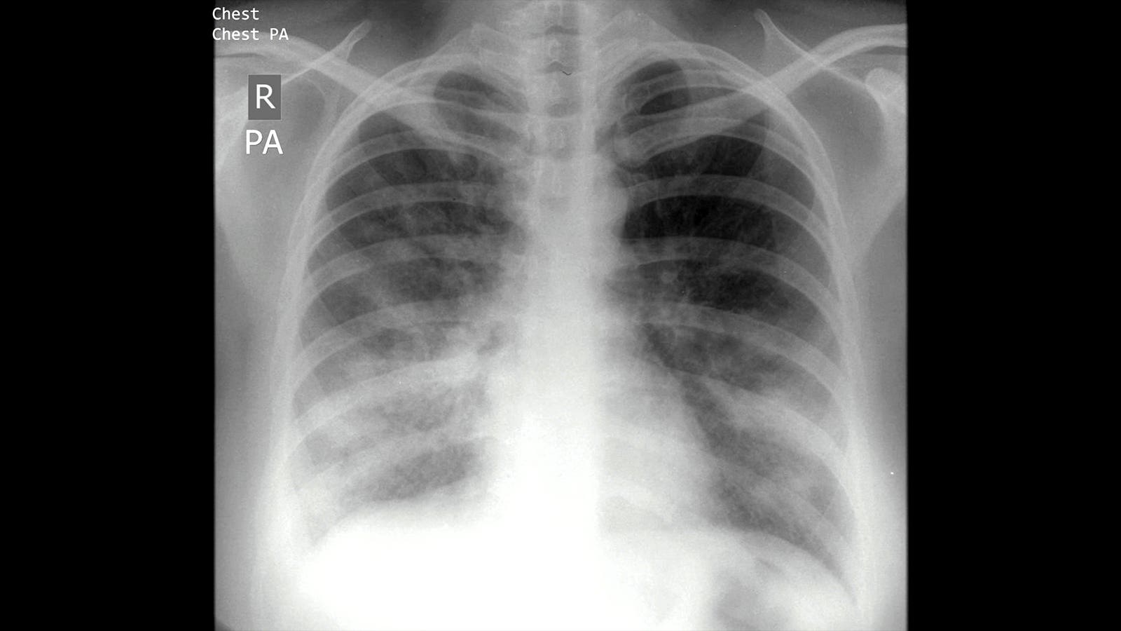 Combination model may improve diagnosis of serious respiratory infections