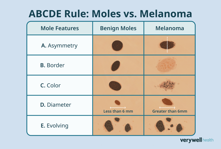 How can you tell if it's melanoma or just a mole?
