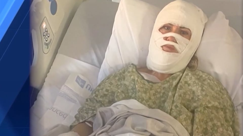 Savannah acid attack victim undergoes first skin graft surgery