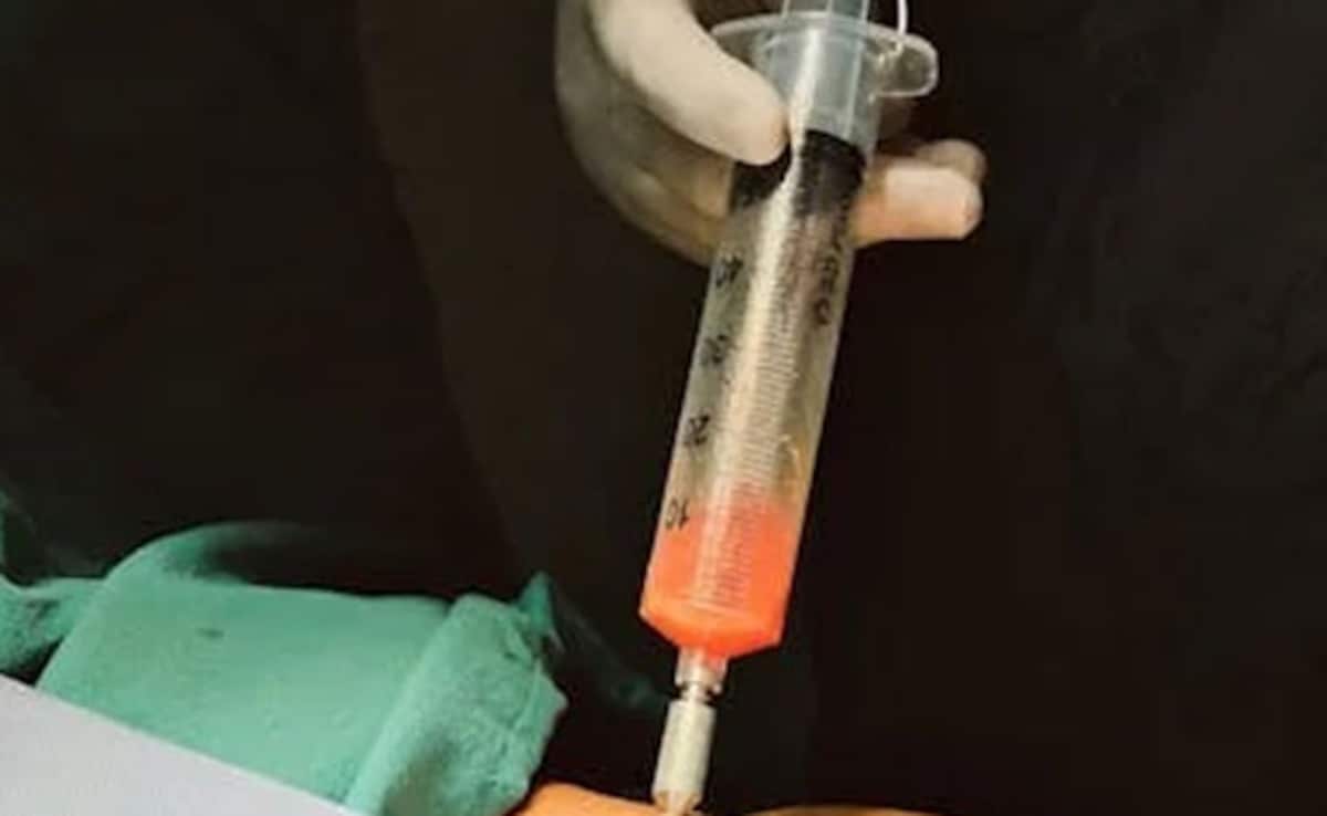 New AI tool can predict blood loss with accuracy during liposuction