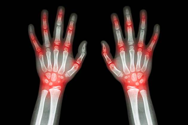 Gout explained in 20 photos