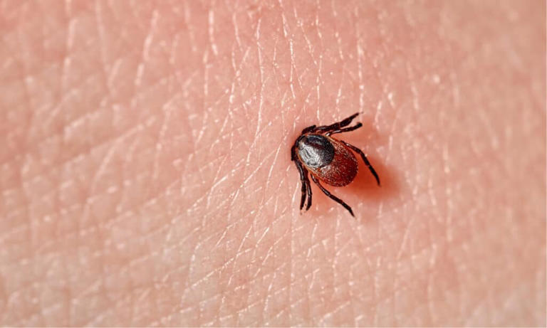 Tick bites: What’s normal, what’s not, and when to get checked