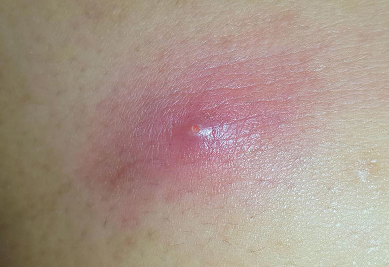 What's the difference between a boil and a cyst?