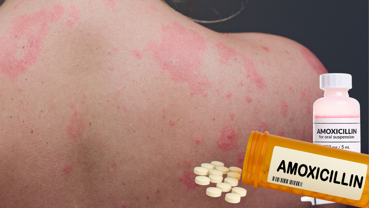 What to do when amoxicillin gives you rashes?